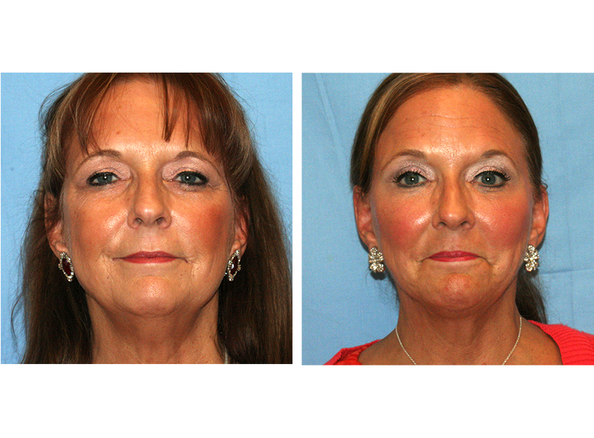 Facelift Gallery – CU Facial Aesthetic Surgery