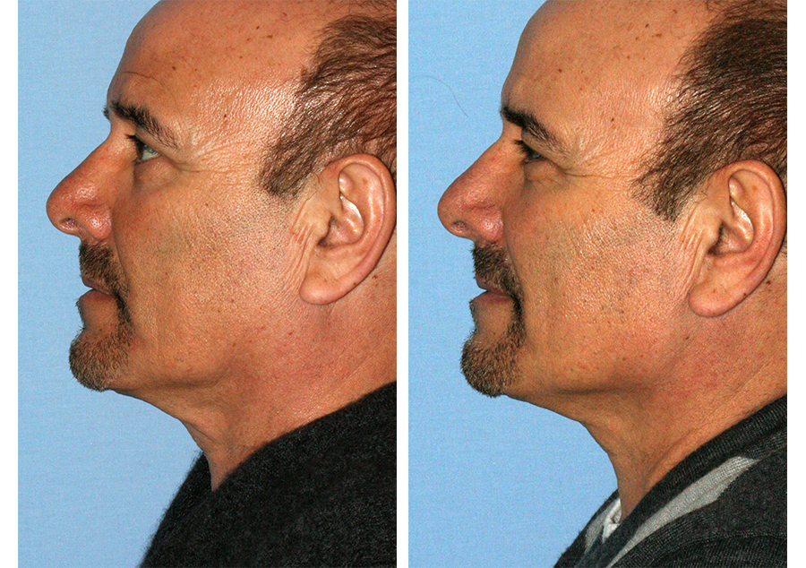 Necklift Gallery – CU Facial Aesthetic Surgery