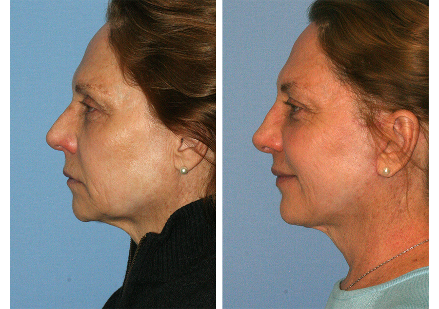 Necklift Gallery – CU Facial Aesthetic Surgery