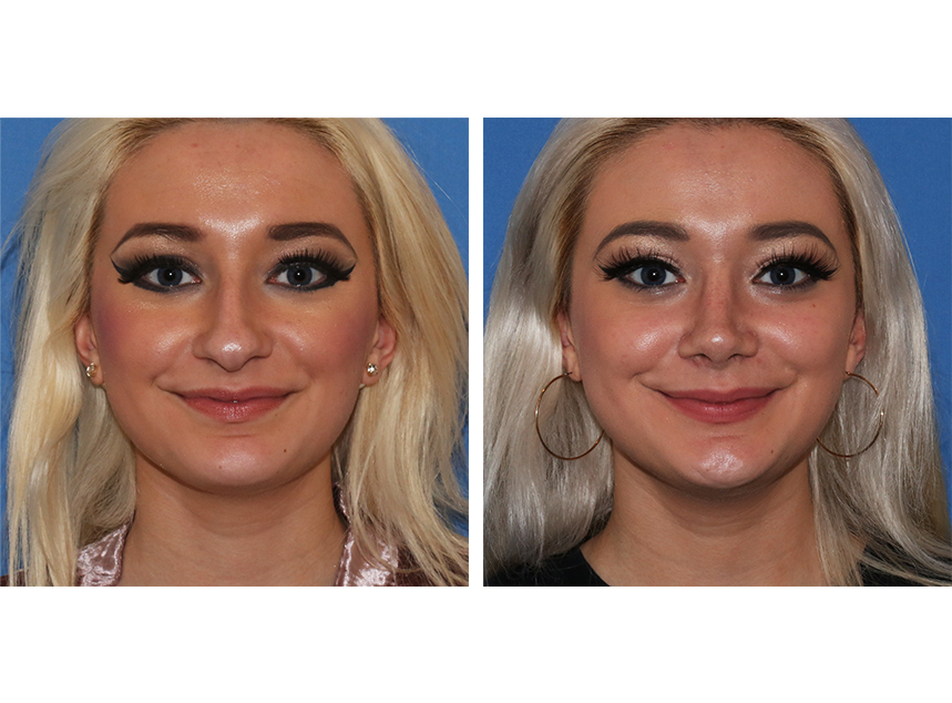 Rhinoplasty Gallery – CU Facial Aesthetic Surgery