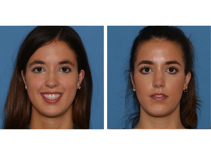 Rhinoplasty Gallery – CU Facial Aesthetic Surgery