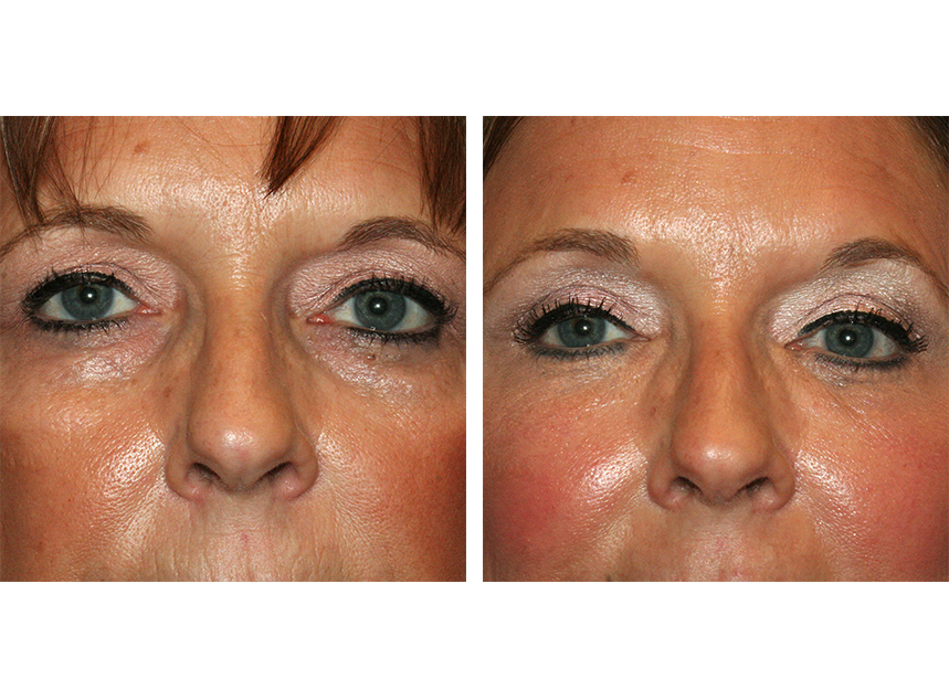 Facial Fat Augmentation – CU Facial Aesthetic Surgery