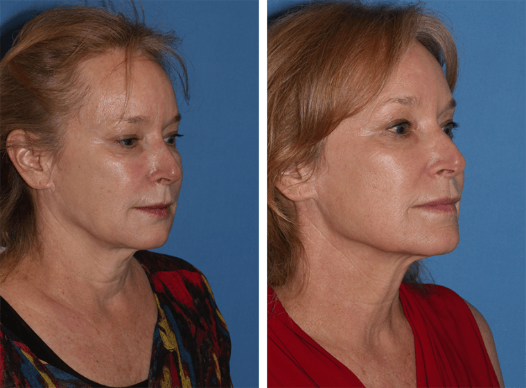 Infini – CU Facial Aesthetic Surgery